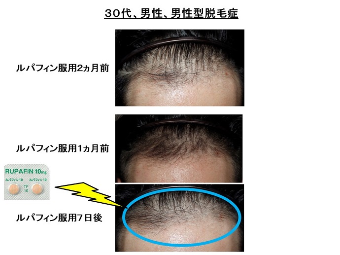 脱毛薬は飲まないように注意していたのに、ルパフィンで脱毛！ 患者様からの声・メディア掲載・クリニックからのお知らせ 名古屋kクリニック